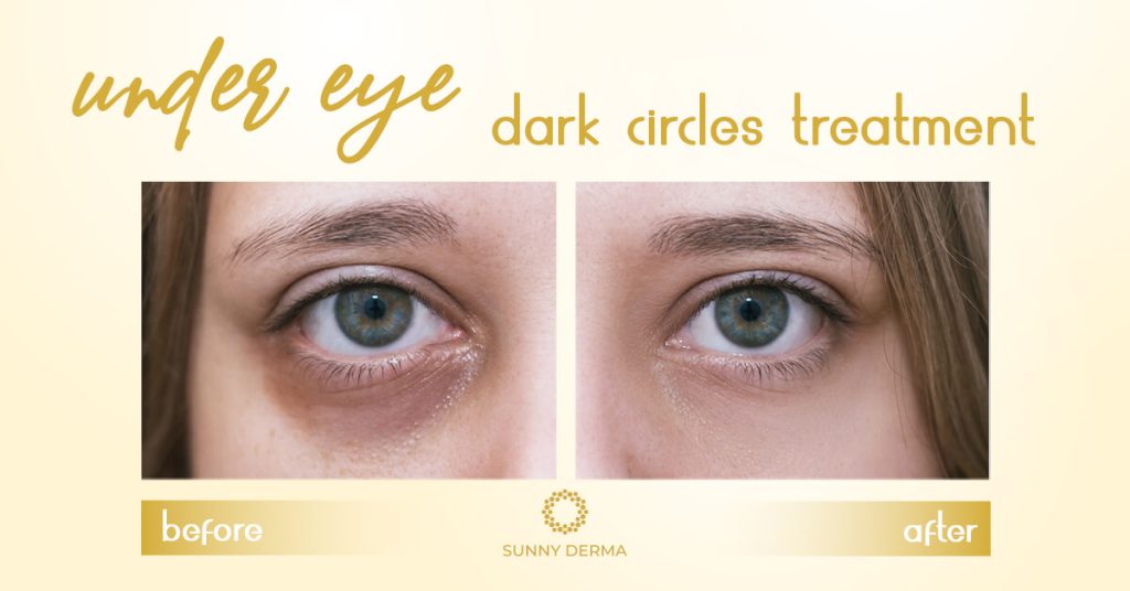 Dark Circles under Your Eyes? Dermal Fillers Can Help - Dr. Sunny ...