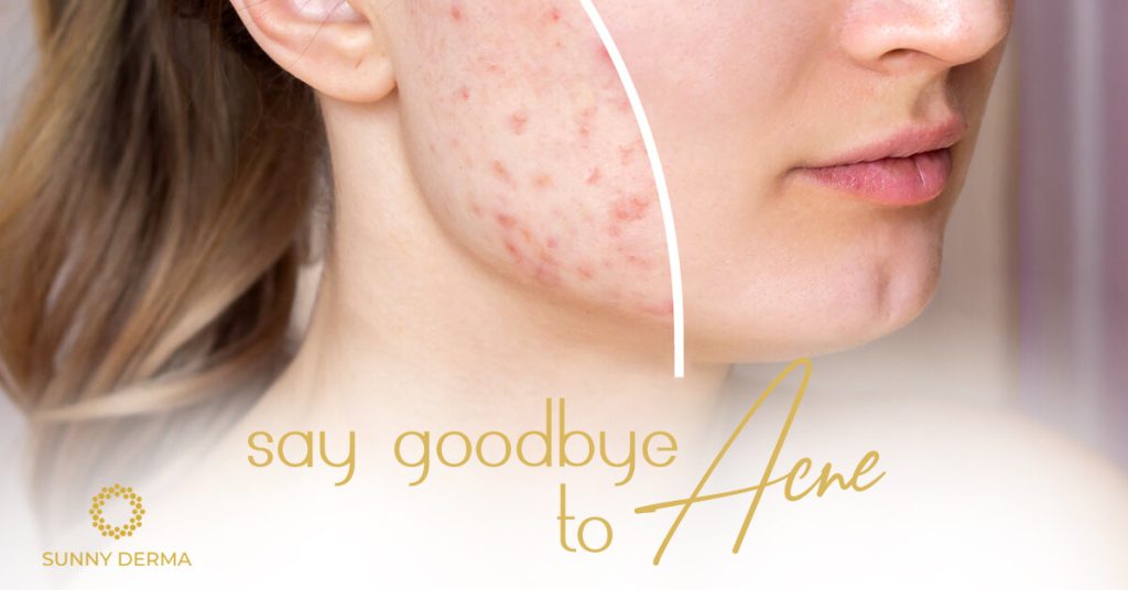 What’s the best facial to get acne-free skin? - Dr. Sunny Medical Centre